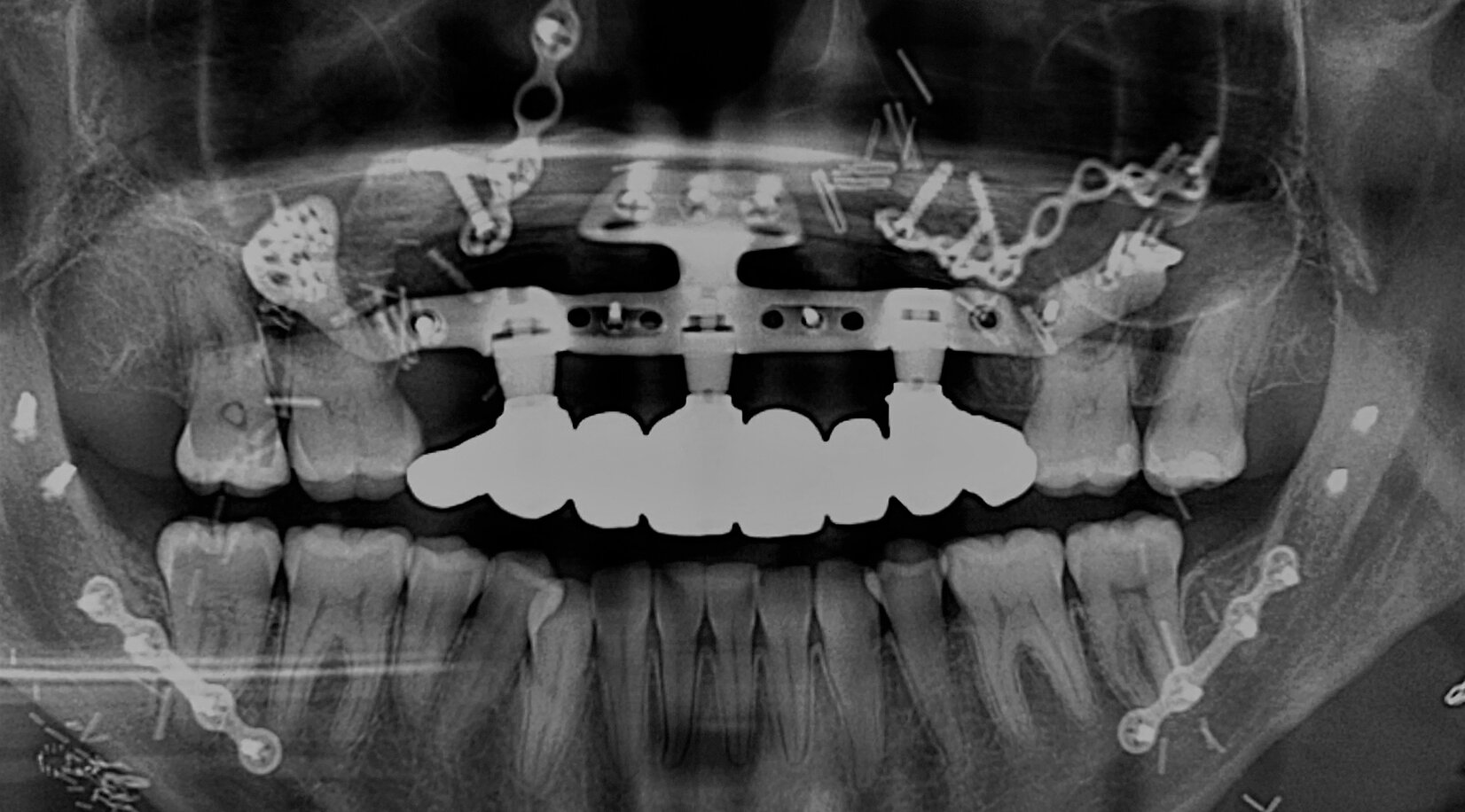 Solución OMX: impresión 3D para cirugía craneomaxilofacial EOS GmbH